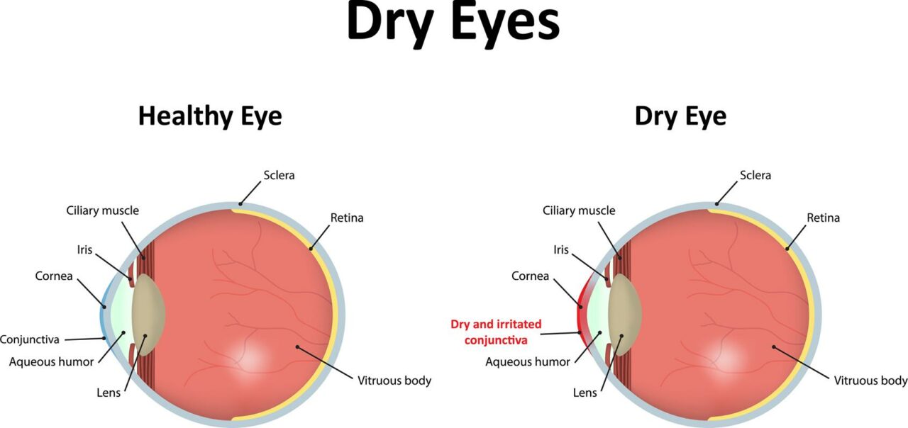 Dry Eye Syndrome-Deciphering the Signals for Prompt Treatment ...